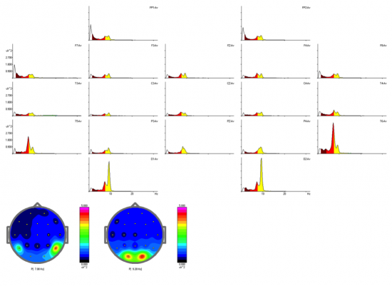 QEEG Brain Mapping - Restore Behavioral Health
