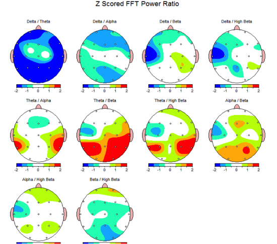 QEEG Brain Mapping - Restore Behavioral Health